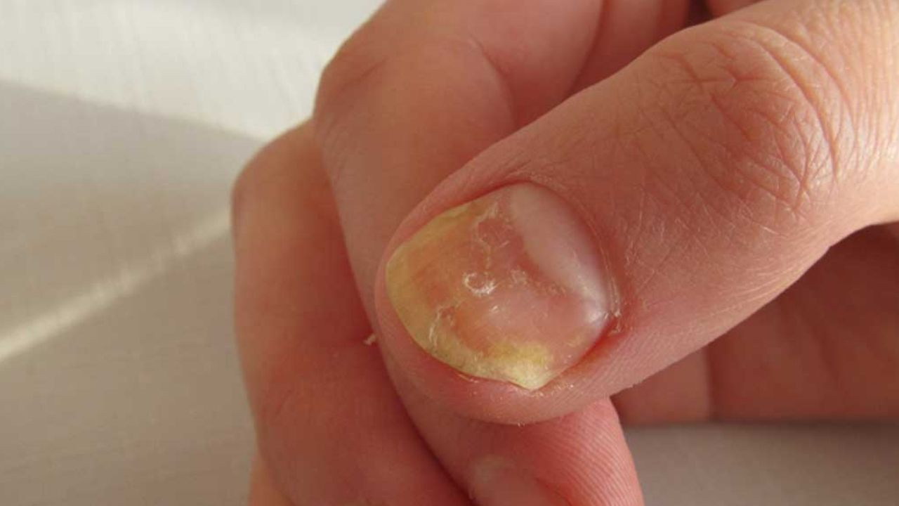 Tırnak mantarı nedir? Tırnak mantarı neden olur?