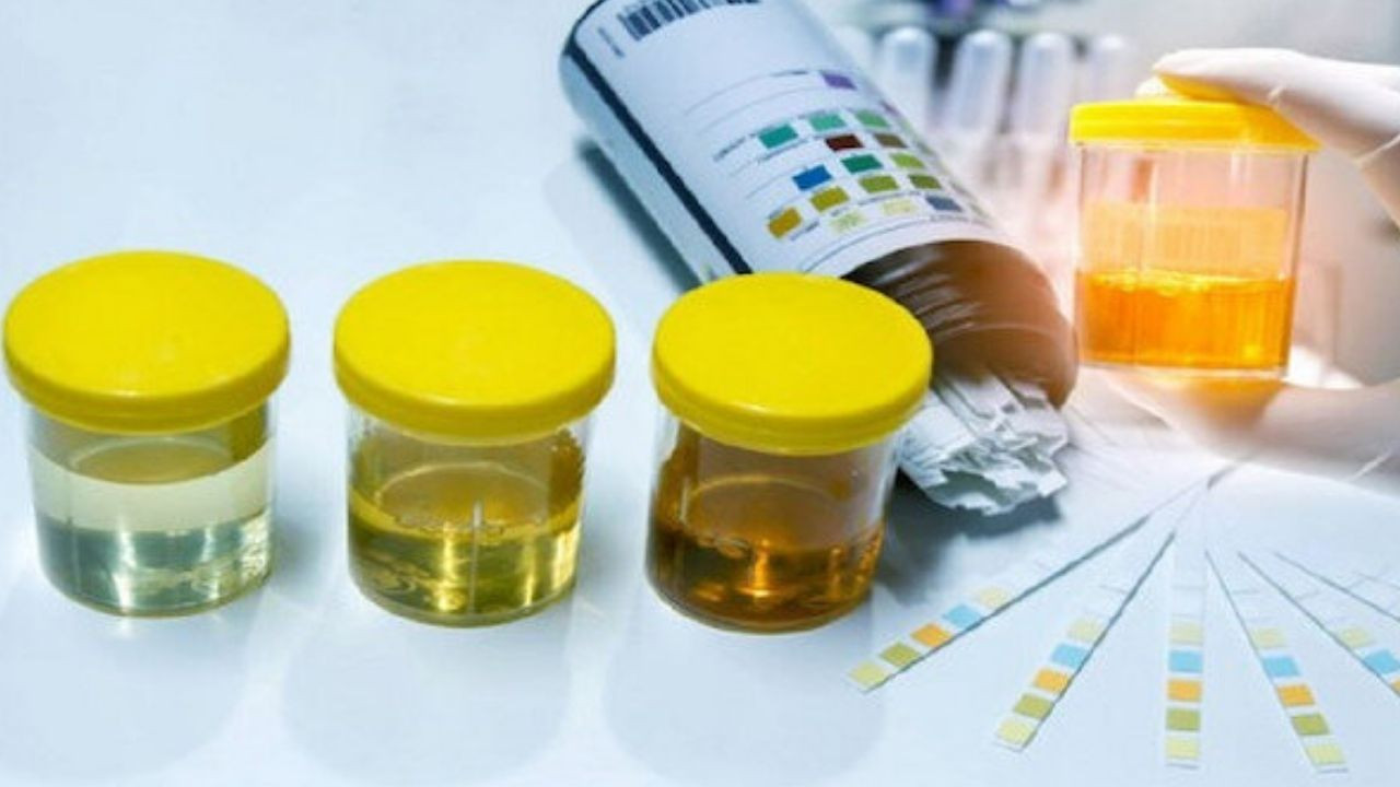 İdrar renklerinin anlamları nelerdir? İdrar renkleri neyi gösterir?
